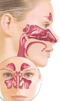 Sinusitis and Sinus Infection | NY Allergy & Sinus Centers